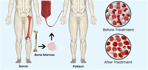 🩸 Battling Acute Lymphoblastic Leukemia A Journey To Hope And Healing 🩸