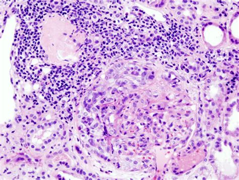 Filecrescentic Glomerulonephritis 2 Wikimedia Commons