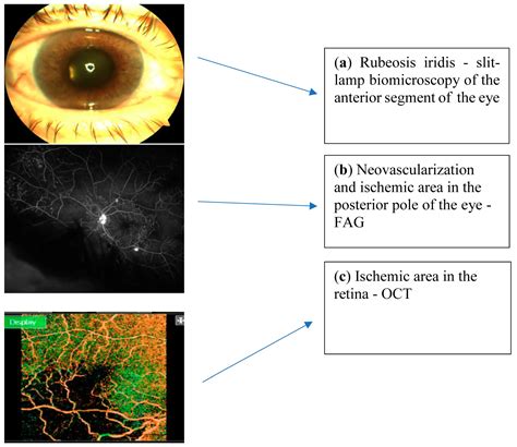 El Iris En Medicina Estructura Funciones Y Enfermedades Botoxina