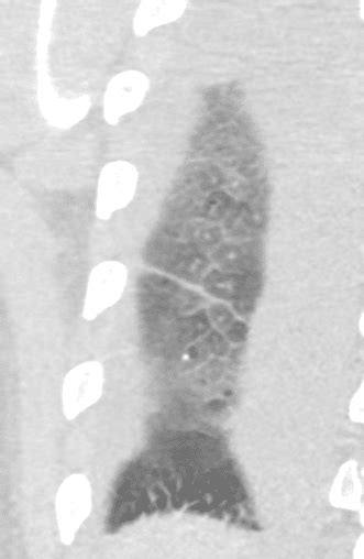 000 Interlobular Septal Thickening The Common Vein