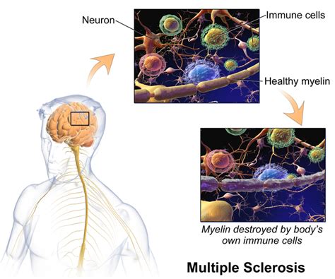 Difference Between Als And Ms Definition Pathophysiology Cause