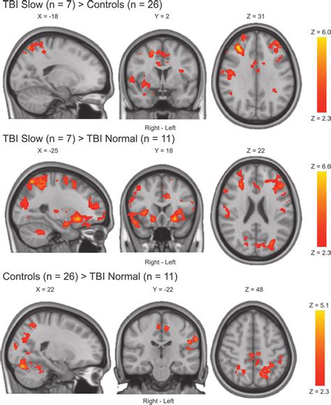 Between Group Differences In BOLD Activation Statistical Parametric Download Scientific