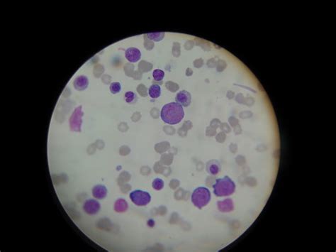 Próeritroblasto Diâmetro 16 A 20µm Alta Relação Núcleoc Flickr