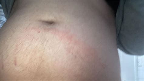 Itchy Red Rash Under Belly Button Any Ideas Rdiagnoseme
