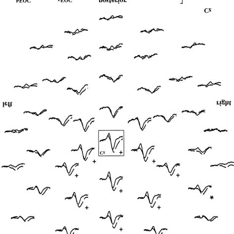Steady State Movement Related Cortical Potentials Associated With Download Scientific Diagram