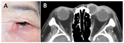 Optimal Timing For Primary Early Endoscopic Dacryocystorhinostomy In