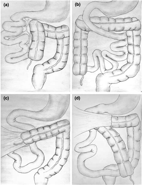 Midgut Malrotation