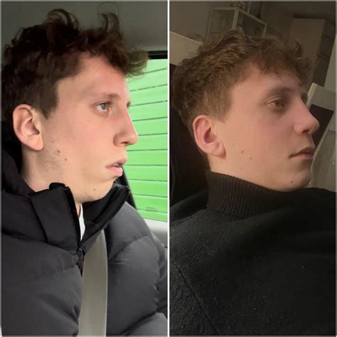 Double Jaw Surgery Genioplasty 15 Months Post Op My Airway Has