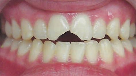 Dental Trauma Pimpama City Dental Centre