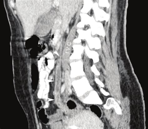 Sagittal Reformation Of Abdominal Ct Showing Ovarian Vein Thrombosis