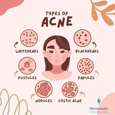 Acne Dubai Healthcare City Westminster Ortho Med Clinic