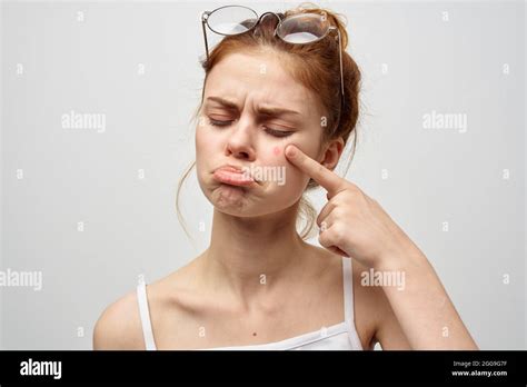 Woman With A Pimple On The Face Hygiene Treatment Stock Photo Alamy