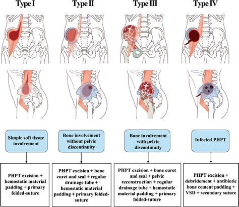 Figure 1 From Surgical Treatment For Pelvic Haemophilic Pseudotumour A