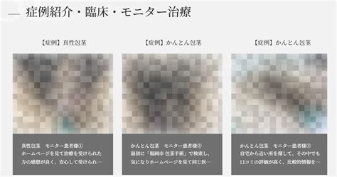 包茎治療 カントン包茎 20代 モニター治療の詳細・臨床写真 東郷美容形成外科 福岡メンズ 福岡天神で包茎治療・亀頭増大