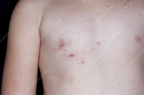 Shingles Rash Chest