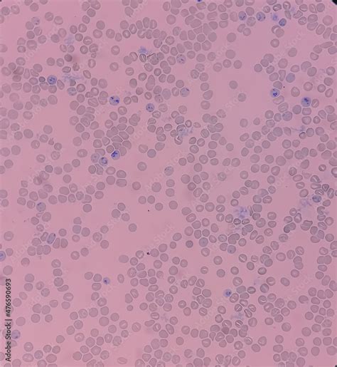 Reticulocyte Count Under Microscope 100x Methylene Blue Staining
