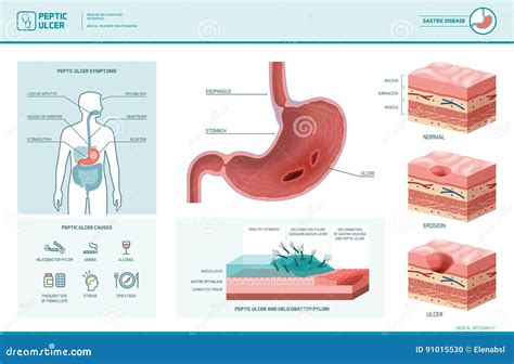 Ulcera Peptica E Helicobacter Pylori Infographic Illustrazione