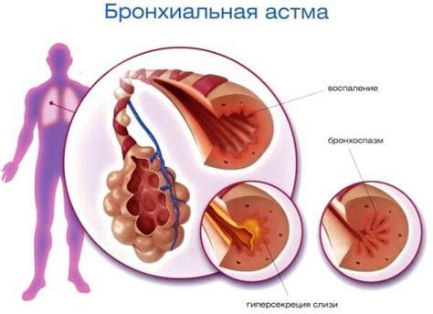 Боль при бронхиальной астме: головная, в спине и груди, острая