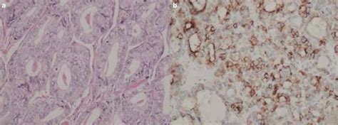 A B A Case Reported As Papillary Carcinoma Follicular Variant H E