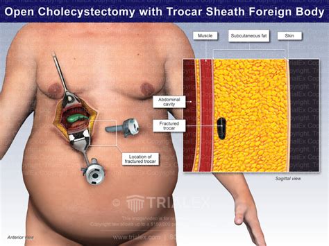 Open Cholecystectomy With Trocar Sheath Foreign Body