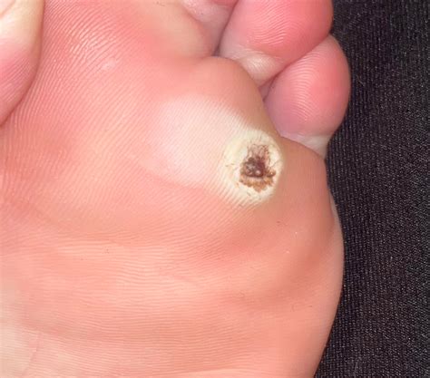 Does This Look Like The Start Of A Plantars Wart If You Think It Is