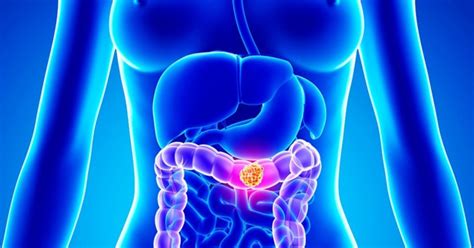 “대장암 환자 지방간 앓으면 암 세포 전이 위험”