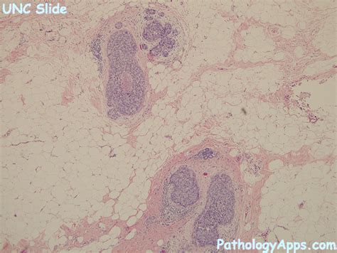 Dcis Pathology