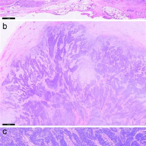 PDF Pathology Of Ectopic Thymic Tumors