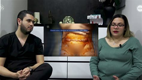 ¡adiós A Las Cicatrices Queloides Youtube