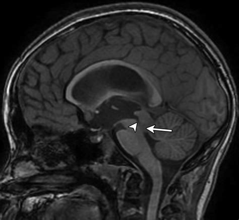 Tectal Glioma In An 11 Year Old Boy With New Onset Ventriculomegaly