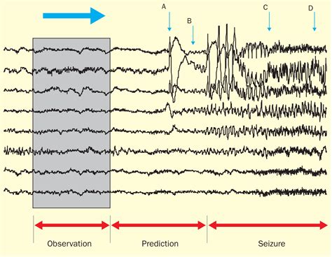 Prediction Of Epileptic Seizures The Lancet Neurology