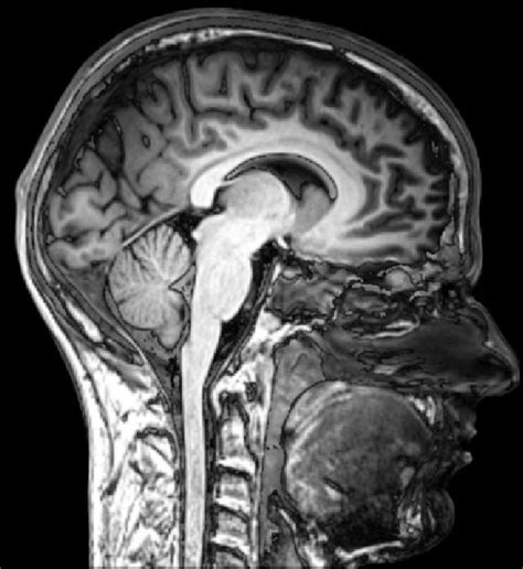 Filemri Brain Sagittal Section Wikimedia Commons