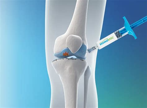 Monovisc Injections Different From The Rest 2024