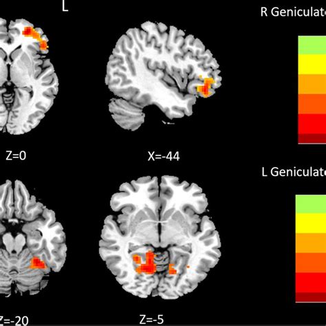 Pdf Altered Lateral Geniculate Nucleus Functional Connectivity In Migraine Without Aura A