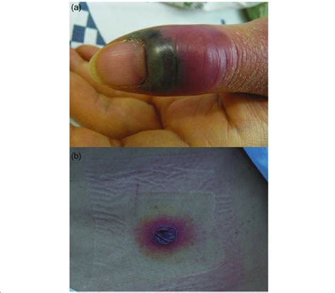 Cellulitis Finger