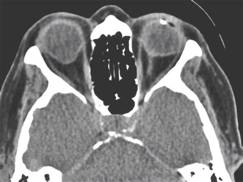 Express Shunt Glaucoma
