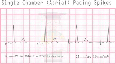 Ecg Educator Blog Pacemakers