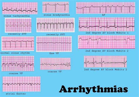 cardiac arrhythmia quotes quotesgram