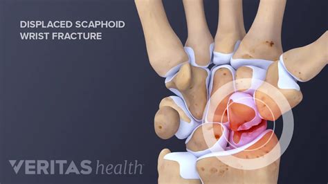Scaphoid Tubercle Fracture