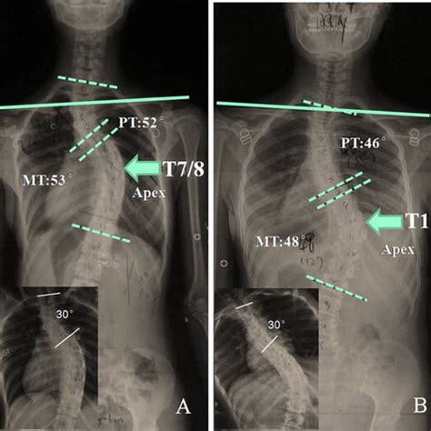 Illustrations Of Complete Proximal Thoracic Curve A Positive T1 Tilt