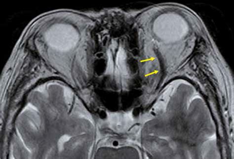 Magnetic Resonance Imaging Of Intraocular Optic Nerve Disorders Review