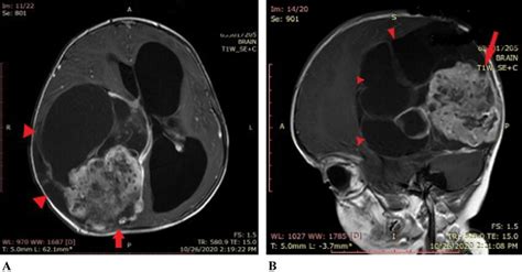 A B Pre Operative Mri Post Contrast Axial And Sagittal Images Show A