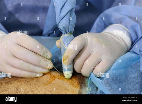 Medical Surgery For Endovenous Laser Photocoagulation Of The Great