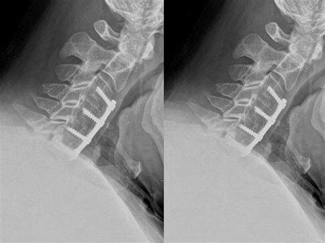 Pseudarthrosis Cervical Spine Ppt