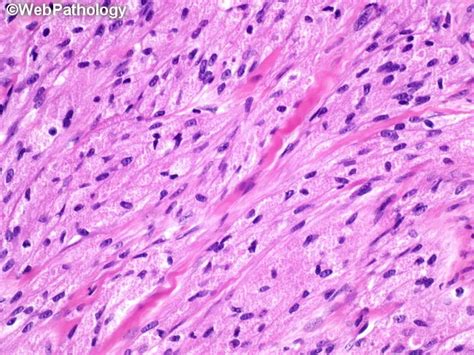Granular Cell Tumor