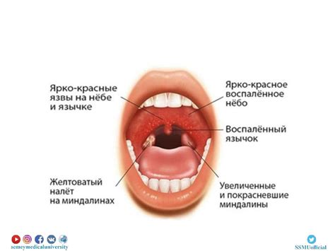 Инфекционный мононуклеоз у детей презентация онлайн