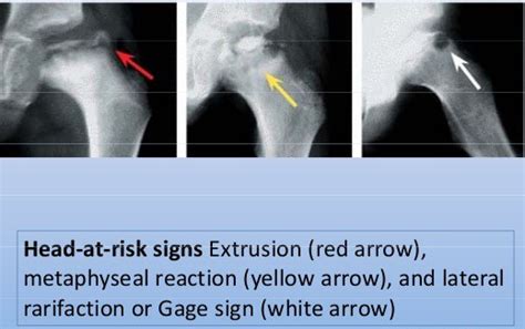 Legg Calve Perthes Disease Coxa Plana Pseudocoxalgia New