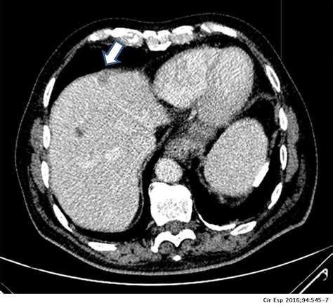 Hepatic Cyst