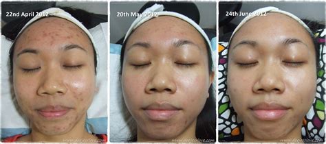 Is This Picture A Realistic Expectation For Red Mark Improvement