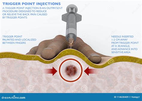A Trigger Point Injection Is An Outpatient Procedure Designed To Reduce Or Relieve The Back Pain